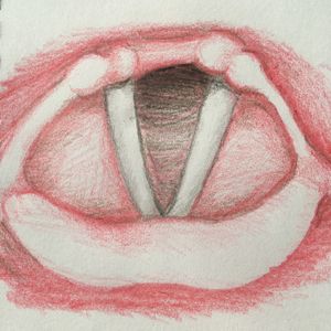 Vocal Cord Dysfunction